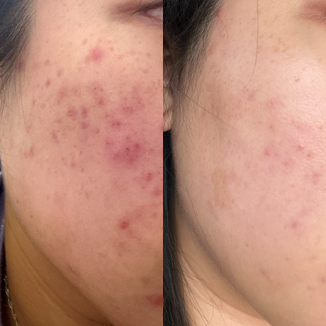 UltraClear Acne Defeating Cleanser - Intense Acne Fighting Action – biomiq