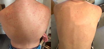 Clear Skin Acne Bundle - Your Complete Acne Solution – biomiq