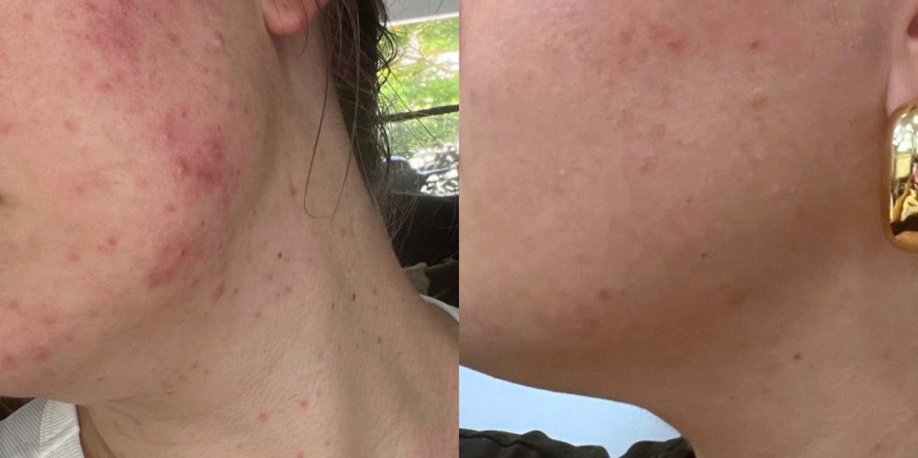 Acne Wipes – biomiq